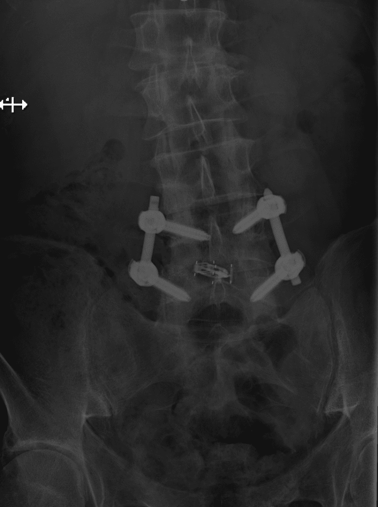 Minimally Invasive Transforaminal Lumbar Interbody Fusion – Prof. Aaron ...